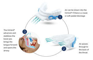 Oventus O2Vent Sleep Apnoea Treatment | Future Dental | Cairns