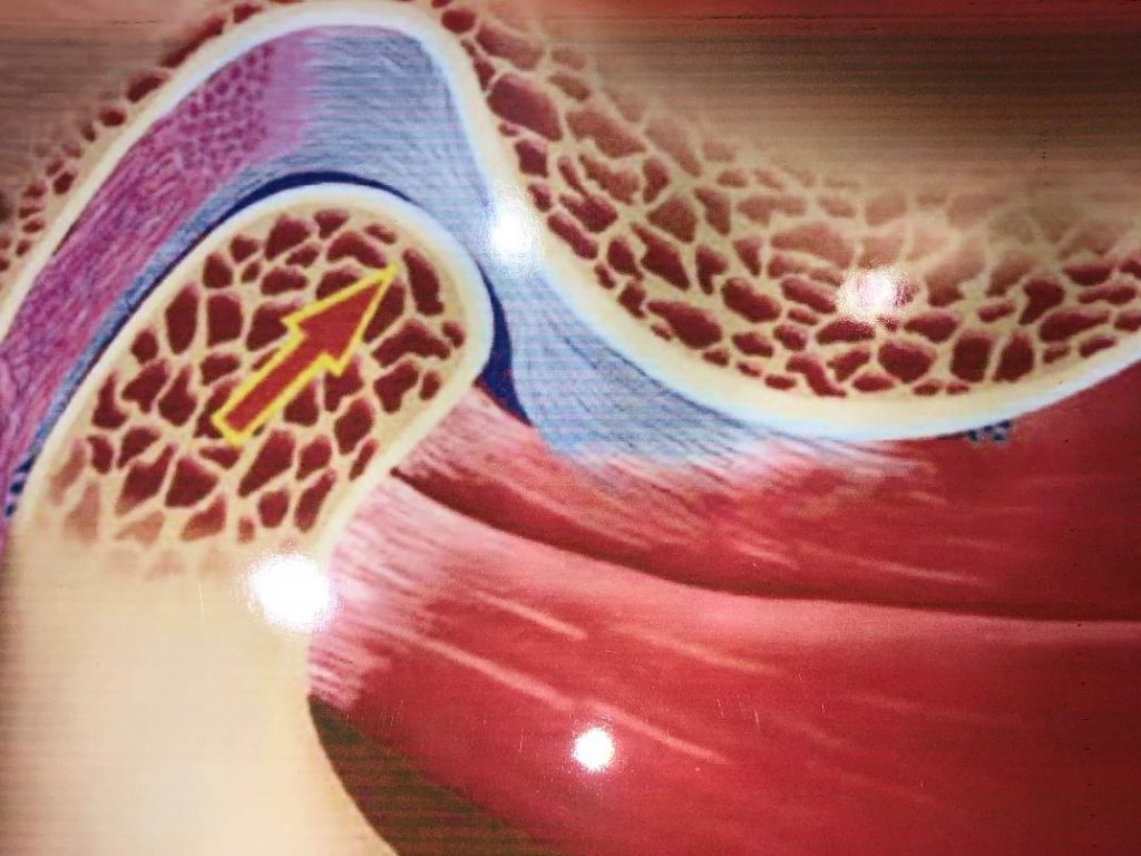 Occlusal Splint Therapy Cairns | TMD Treatment | Future Dental