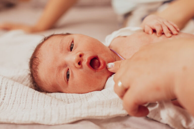 Lip Tongue Ties Impact On Breastfeeding