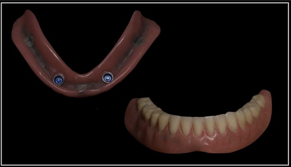 Needing a Full Lower Denture? - Future Dental