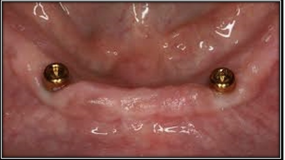 Needing a Full Lower Denture? - Future Dental