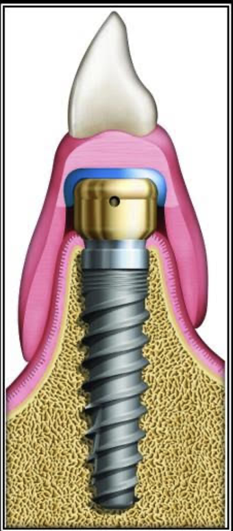 Needing a Full Lower Denture? - Future Dental