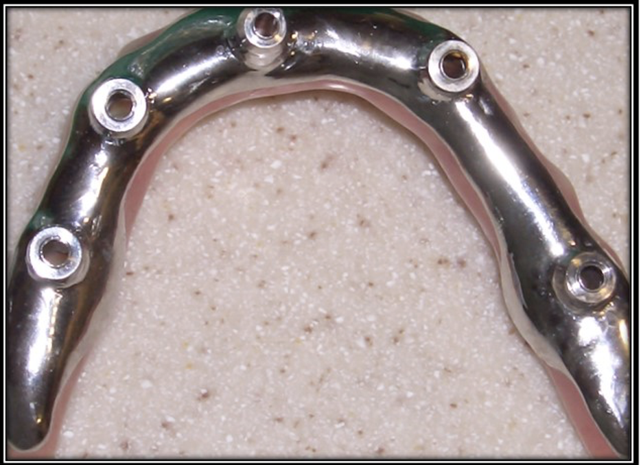 Needing a Full Lower Denture? - Future Dental