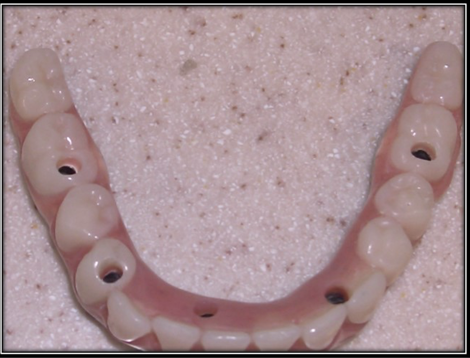 Needing a Full Lower Denture? - Future Dental