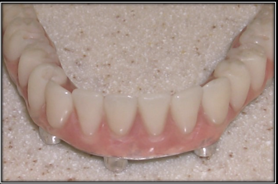 Needing a Full Lower Denture? - Future Dental