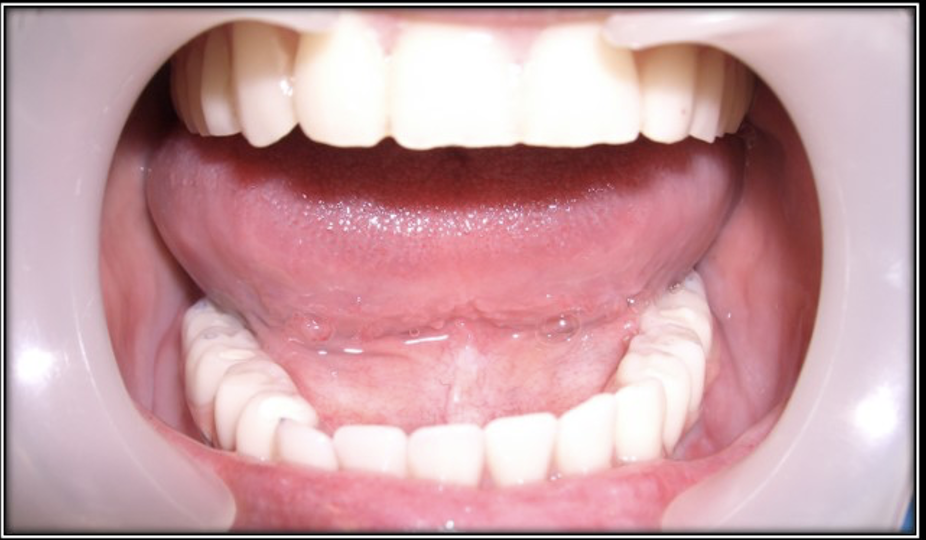 Needing a Full Lower Denture? - Future Dental