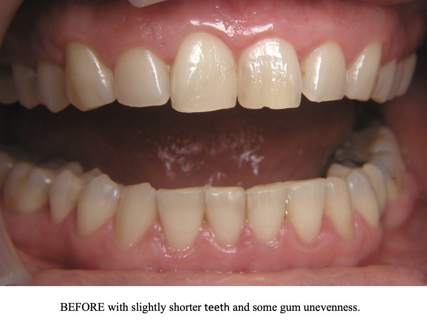 Gum Lifts Cairns | Future Dental