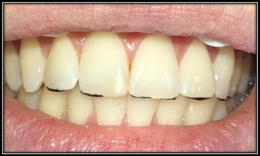 Cairns Tooth Contouring | Future Dental