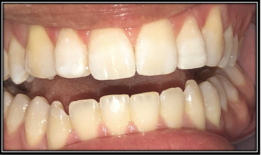 Cairns Tooth Contouring | Future Dental
