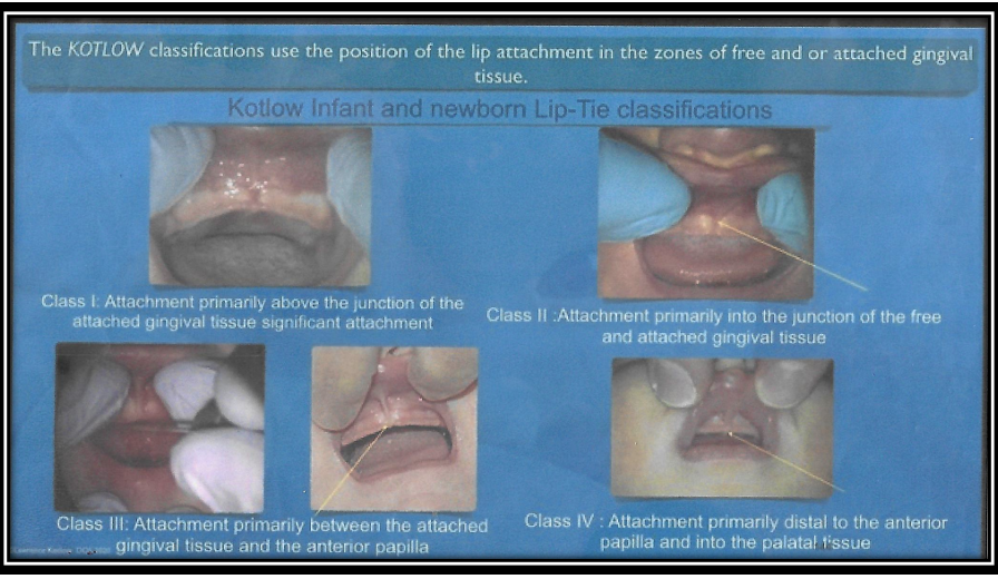 Lip and Tongue Tie Treatment Cairns | Future Dental
