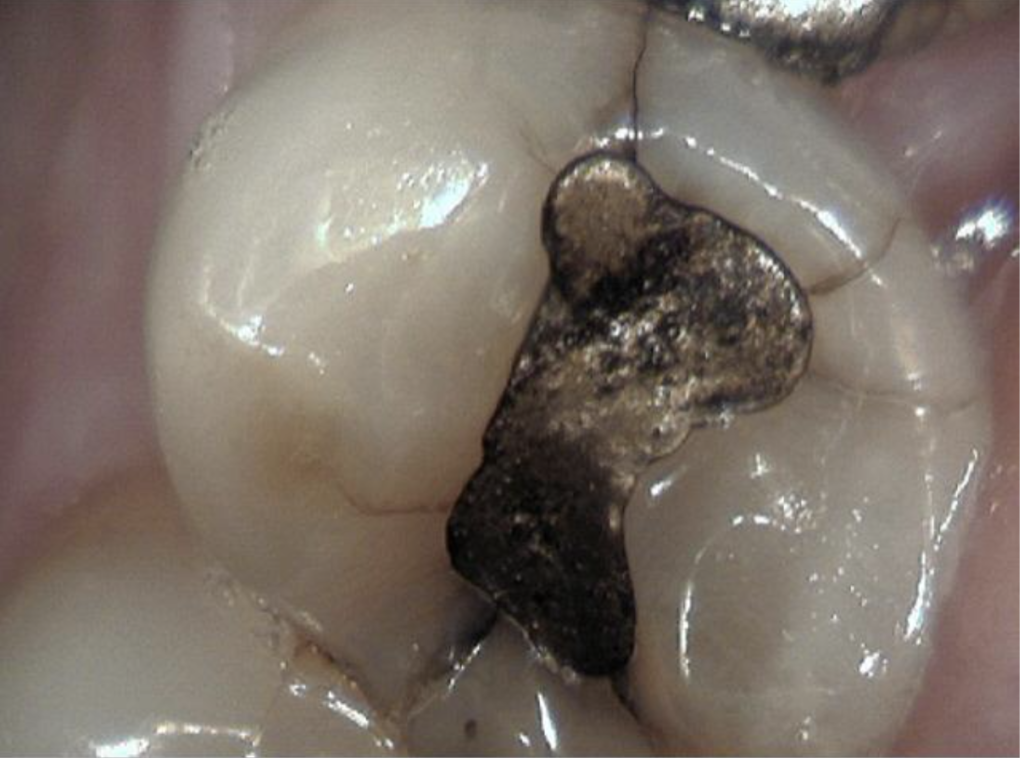 Amalgam Filling Replacement Cairns | Future Dental