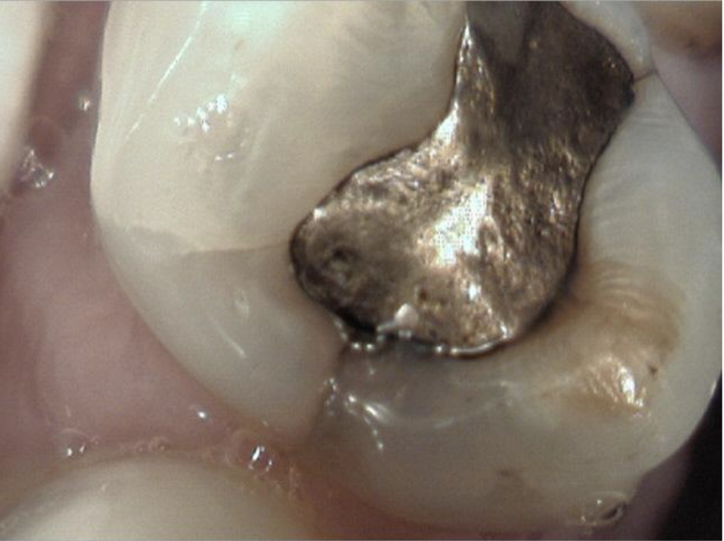 Amalgam Filling Replacement Cairns | Future Dental