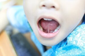 Tongue Ties: Causes & Effects on Oral Health